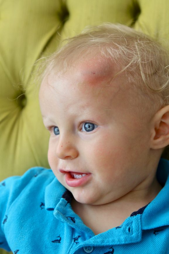 Help for Toddler Bumps & Bruises - Paging Supermom