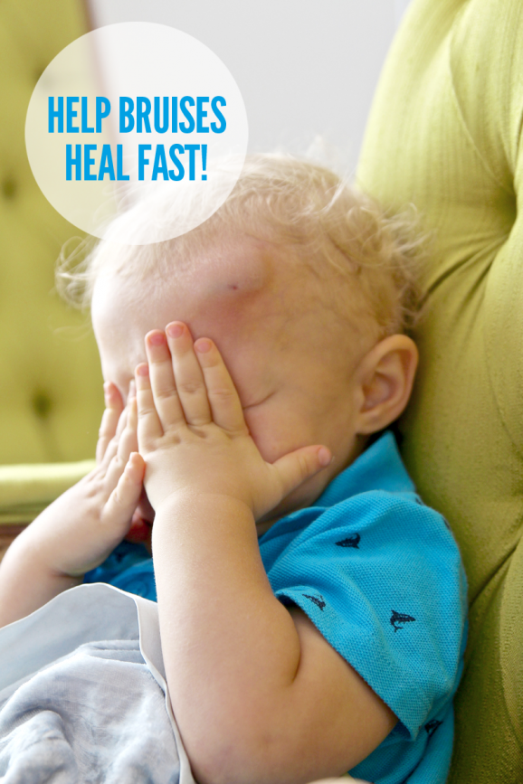 Help for Toddler Bumps & Bruises - Paging Supermom